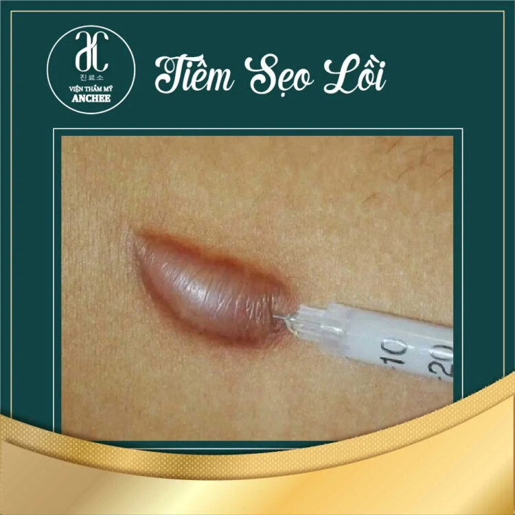 Tiêm Sẹo Lồi - Phương Pháp Làm Đẹp An Toàn, Hiệu Quả